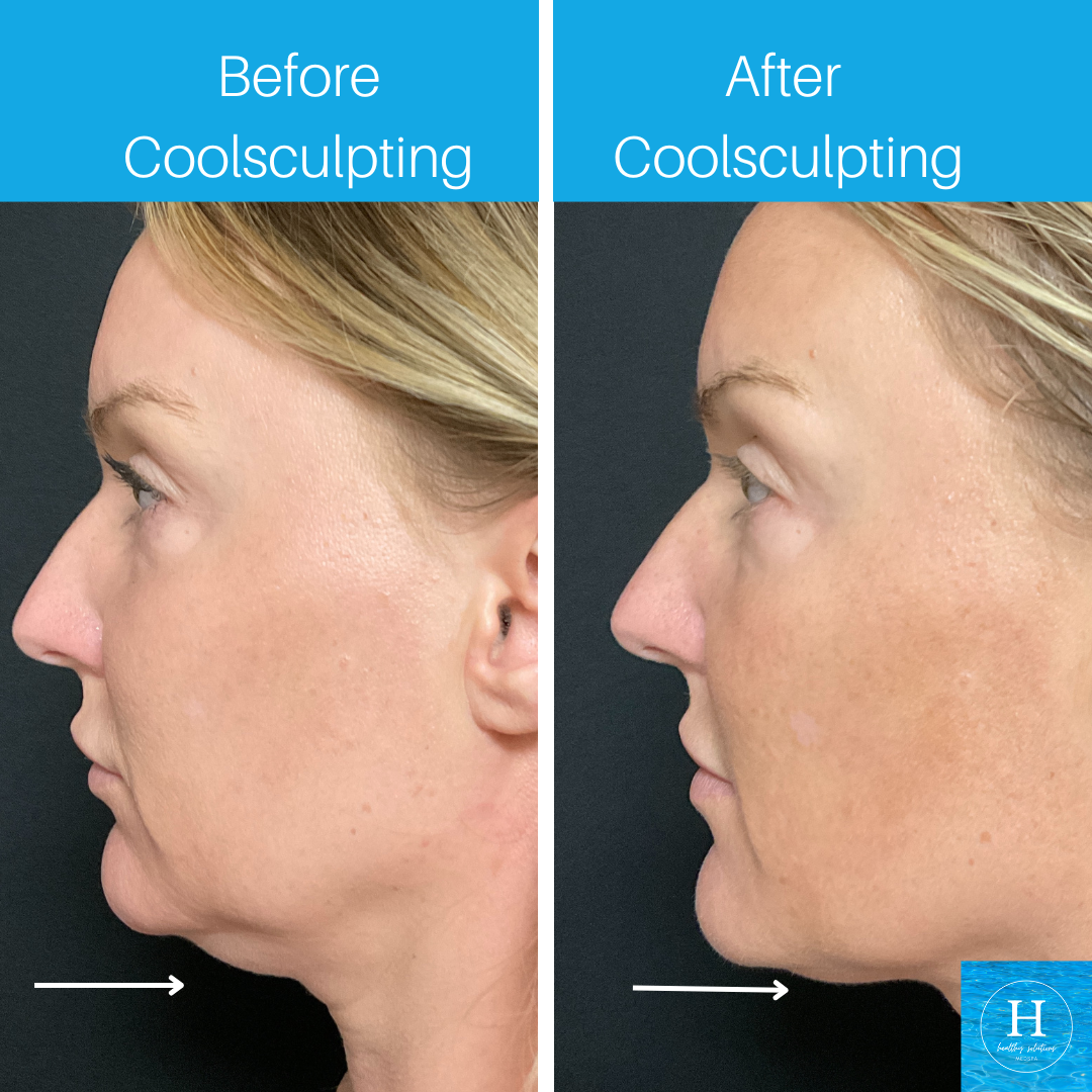 Chin Fat Reduction With CoolSculpting. Improve Your Selfie.
