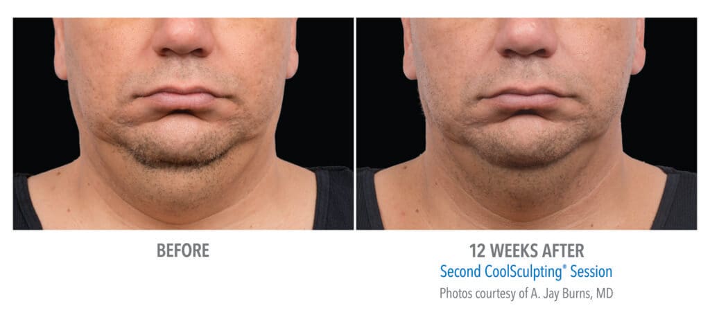 Chin Fat Reduction Treatments