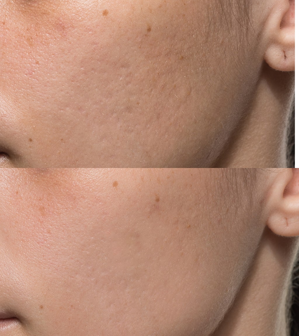 Bellafill | Treatment for Reducing Acne Scars | FDA Cleared