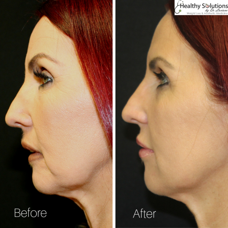Cheek Injections Dermal Fillers: Before & After | Healthy Solutions