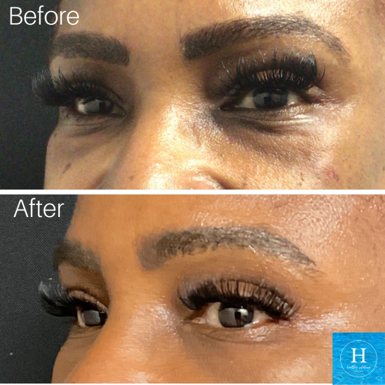 Under Eye Filler Injections | Before And After | Healthy Solutions PA