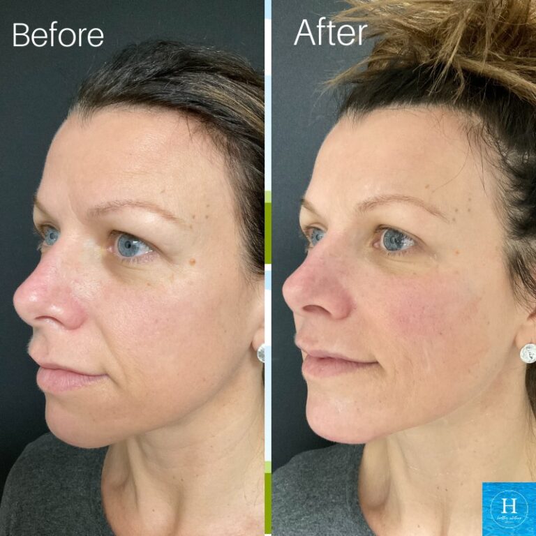 Cheek Injections Dermal Fillers: Before & After | Healthy Solutions