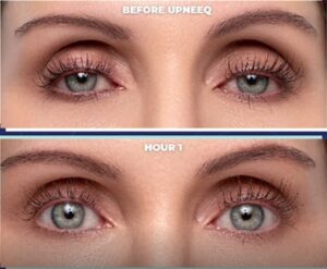 What is Upneeq? | Healthy Solutions Medspa