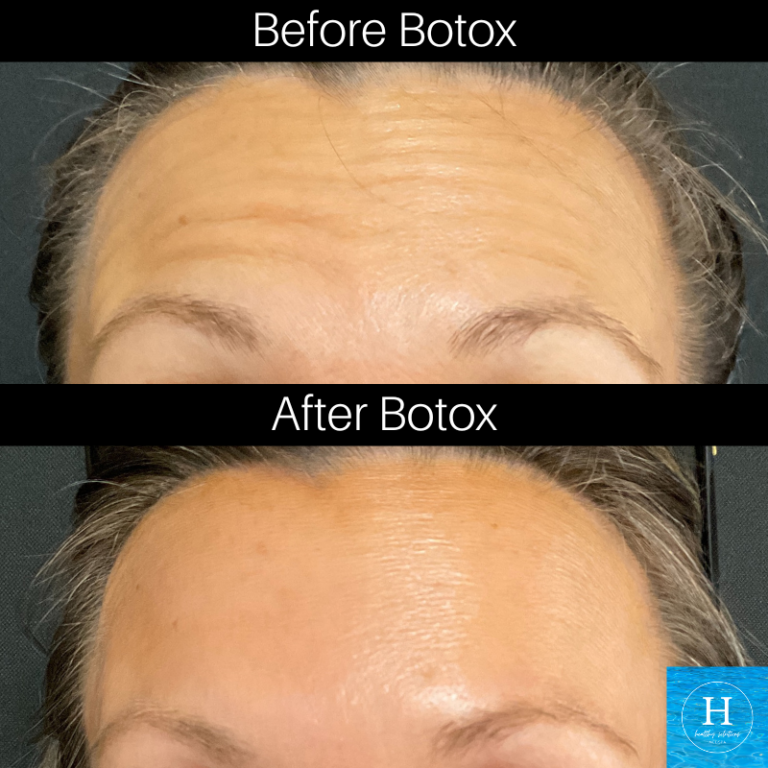 Longevity of Botox and How Quick it Kicks In | Healthy Solutions Medspa®