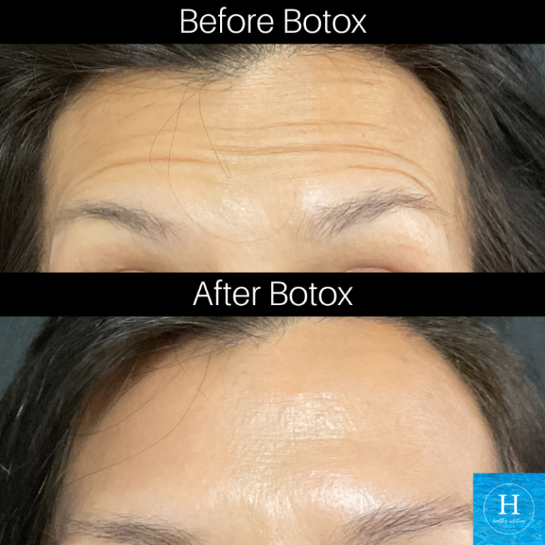 Counterfeit Botox: How to Know The Botox You Receive is Safe | Healthy ...