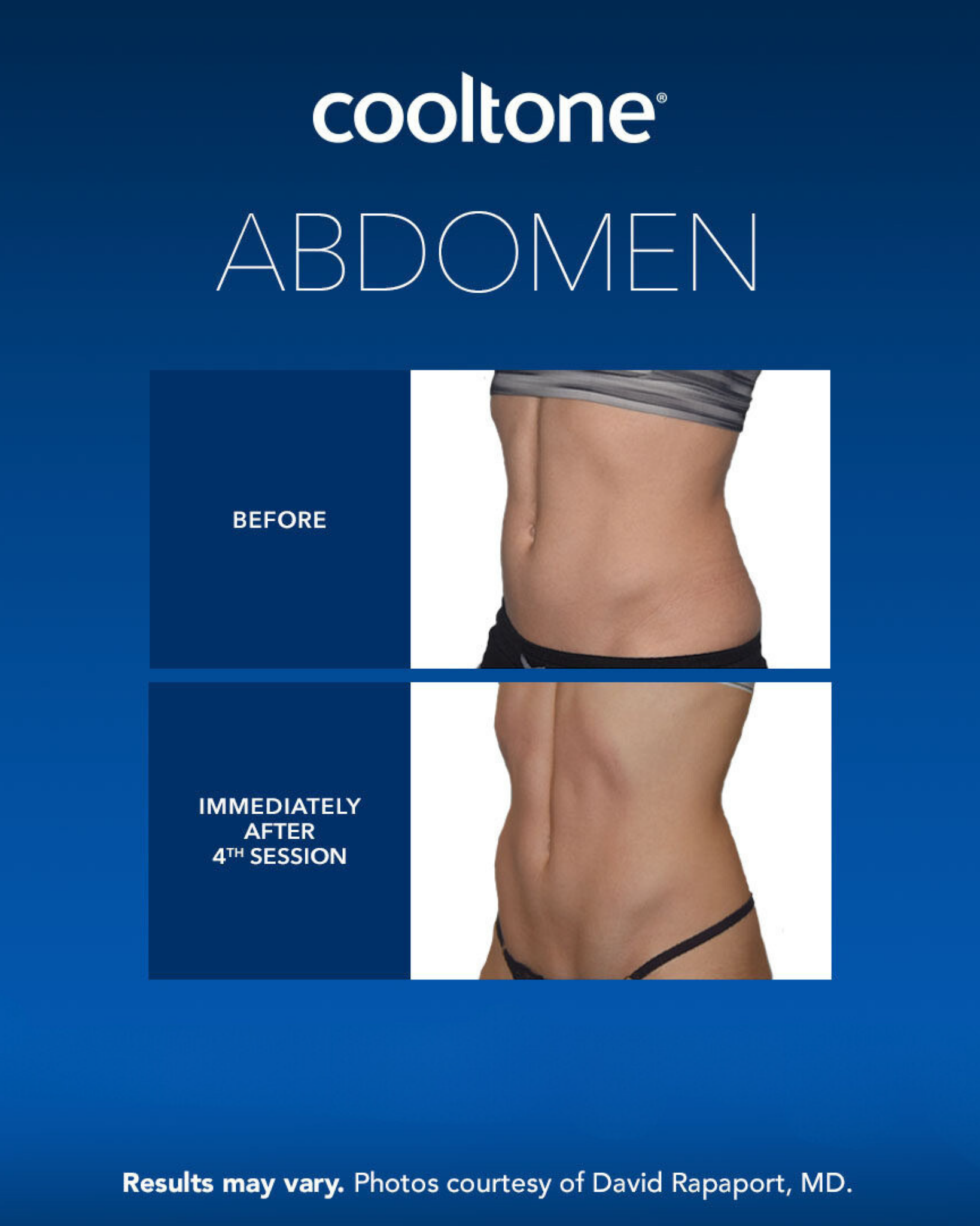 Bounce Back After Baby: How CoolSculpting and CoolTone Can Help You Feel Your Best | Healthy ...