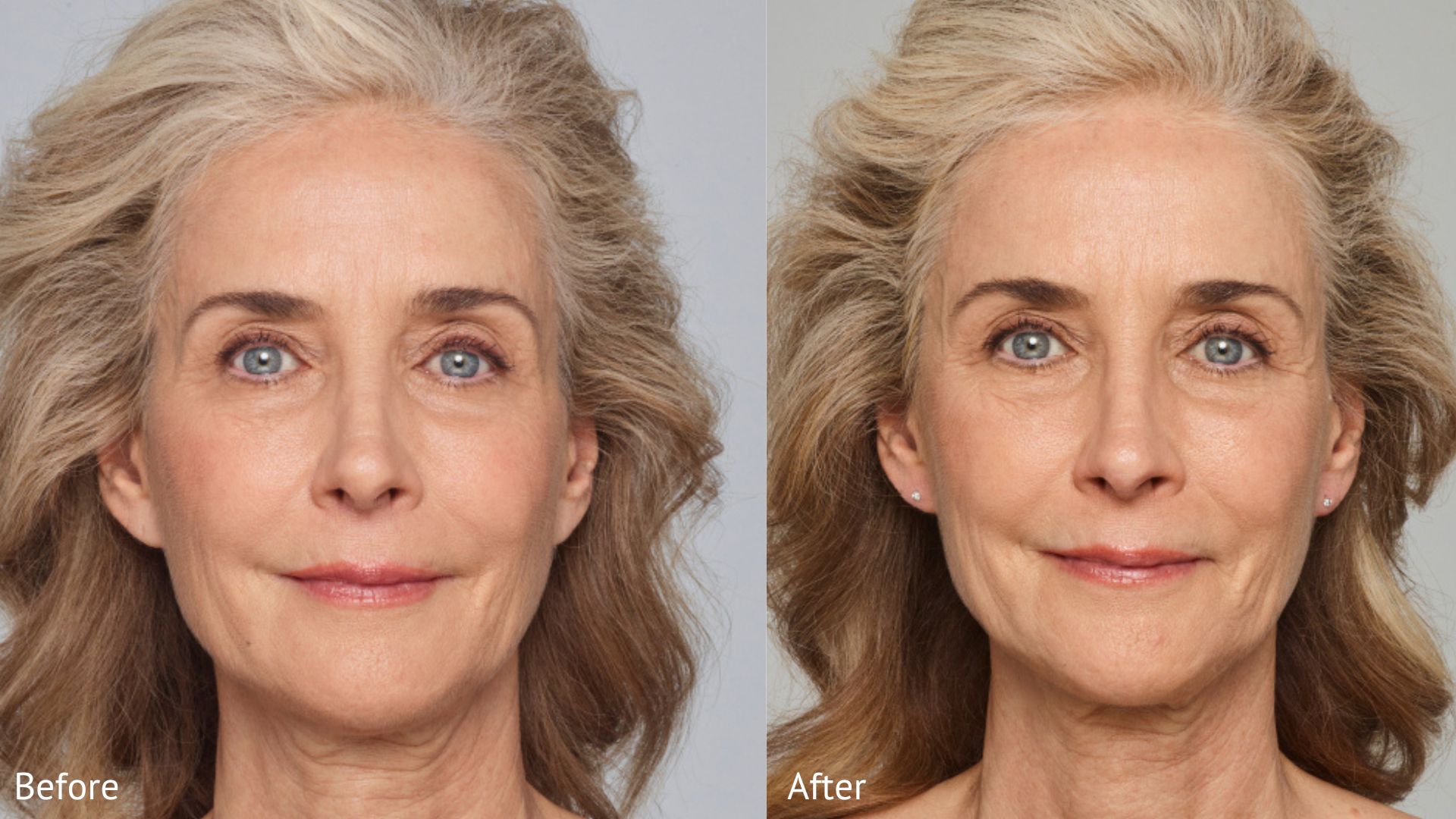 Juvederm Voluma Now FDA Approved for the Temples | Healthy Solutions ...