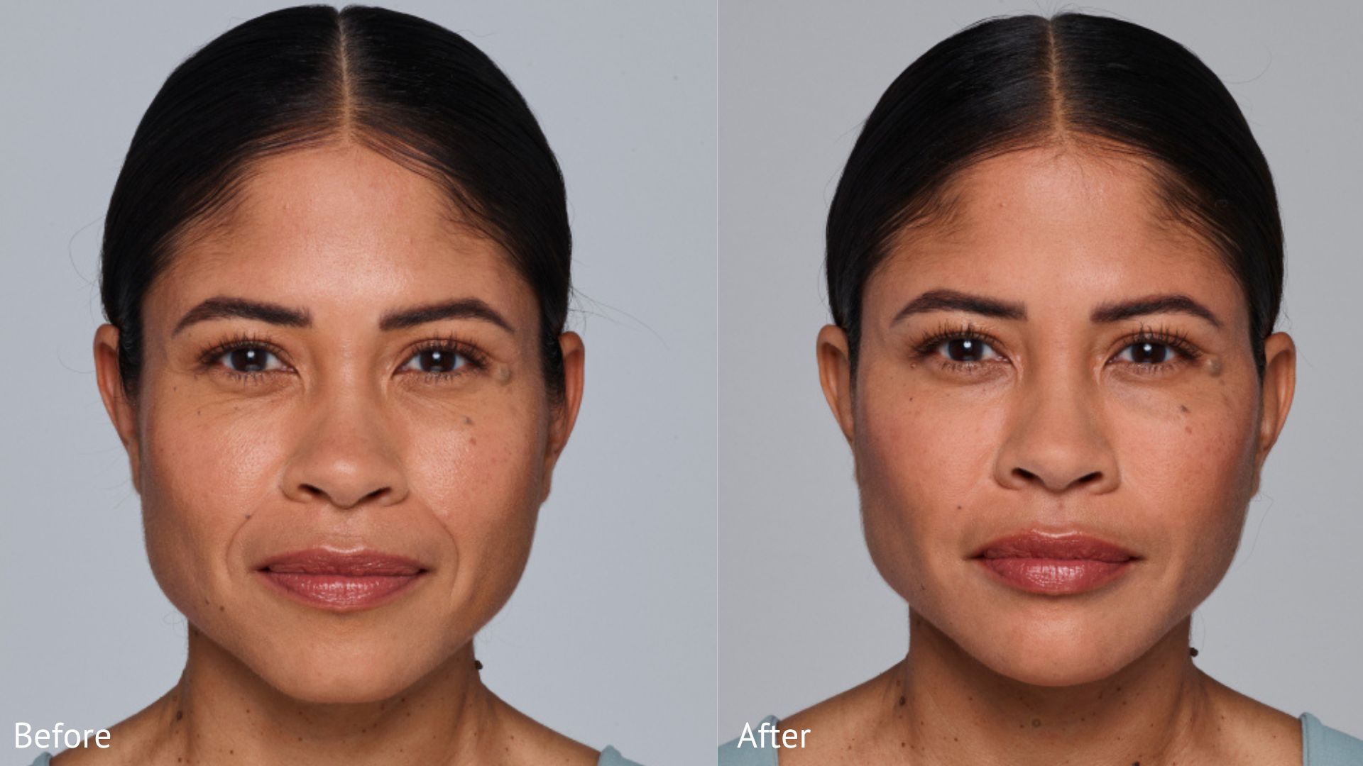 Juvederm Voluma Now FDA Approved for the Temples | Healthy Solutions ...