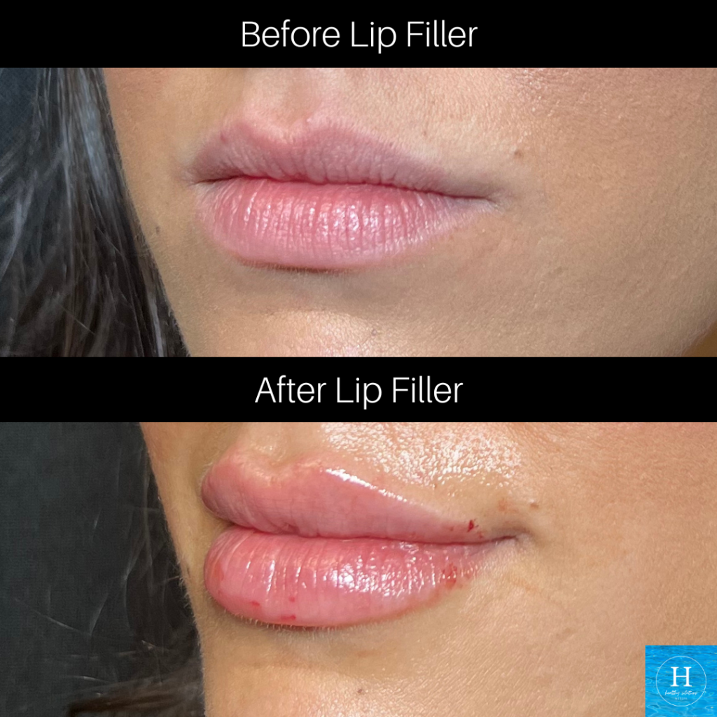 Everything You Need to Know About Mini Lip Filler Treatments