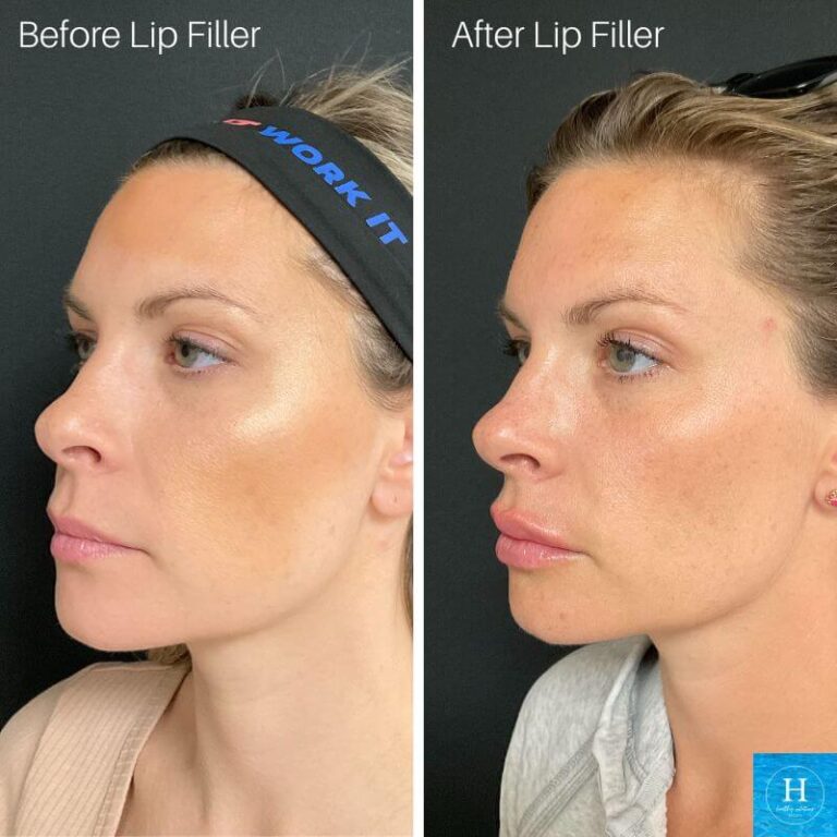 Everything You Need to Know About Mini Lip Filler Treatments