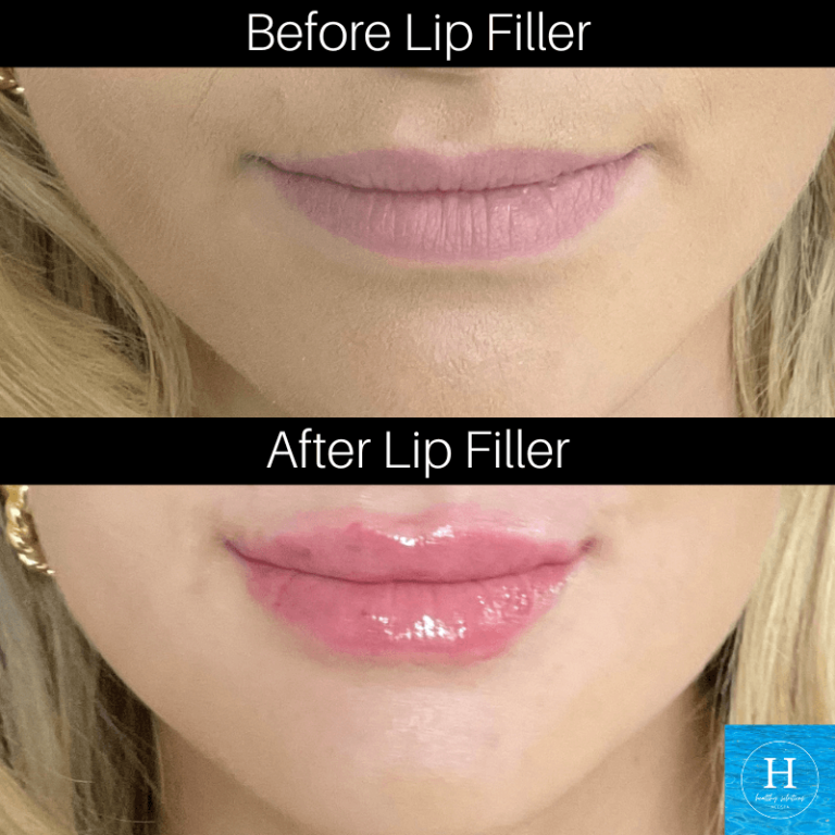 Everything You Need to Know About Mini Lip Filler Treatments