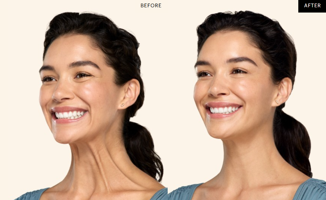 Botox for Platysma Bands: A Non-Surgical Solution for a Youthful Neck